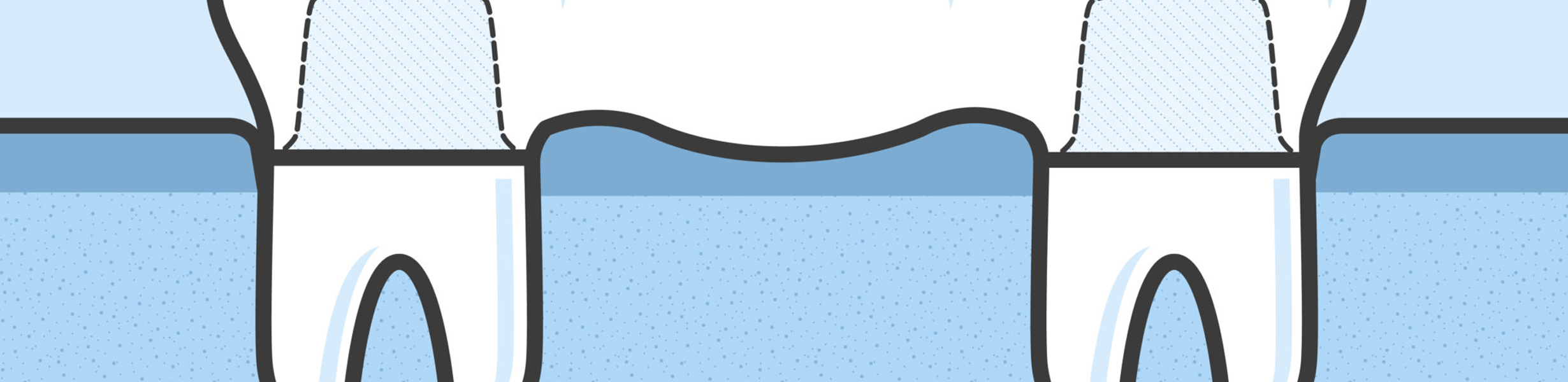 Dental Bridge | Tooth Bridge | Fill The Gap | Auckland