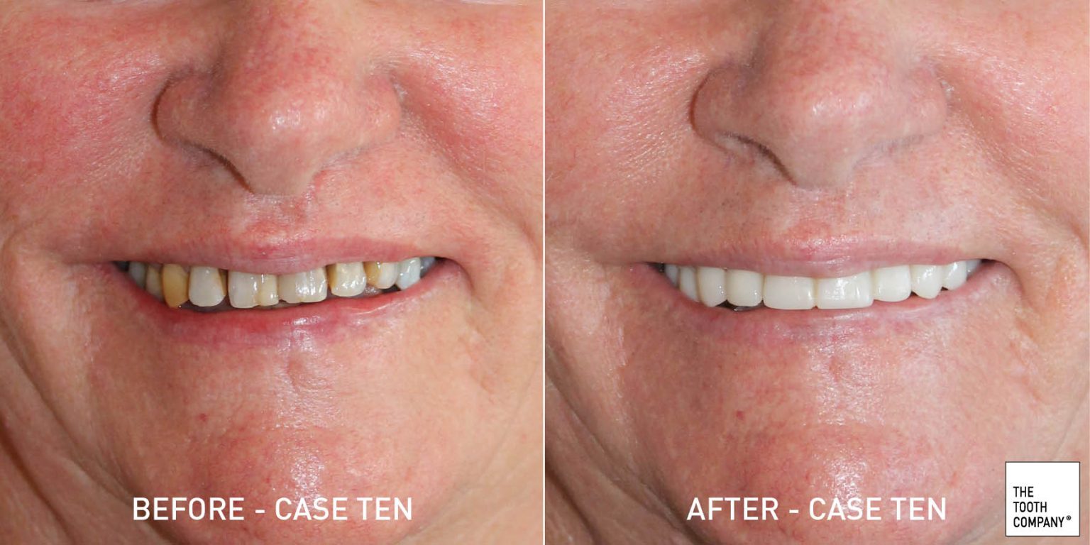 Bad Teeth | Teeth are falling apart | Smile makeover