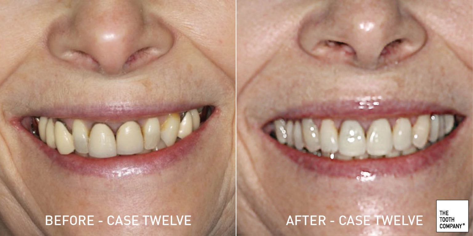 Bad Teeth | Teeth are falling apart | Smile makeover