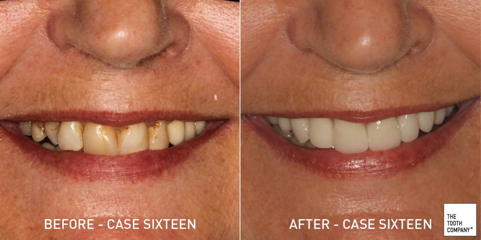 Bad Teeth | Teeth are falling apart | Smile makeover